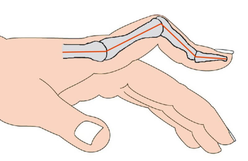 Boutonniere Deformity – Symptoms, Diagnosis, Treatment